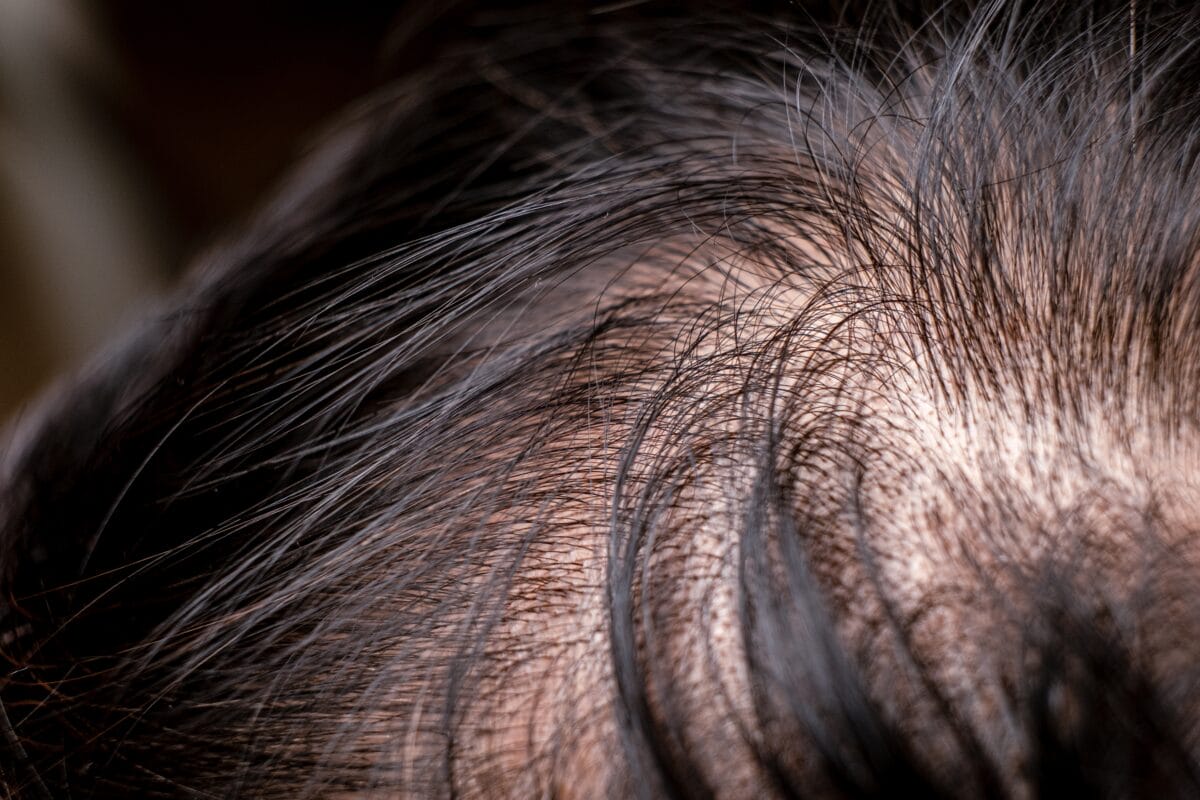 What is Anorexia and Does It Cause Hair Loss? | Sober Speak